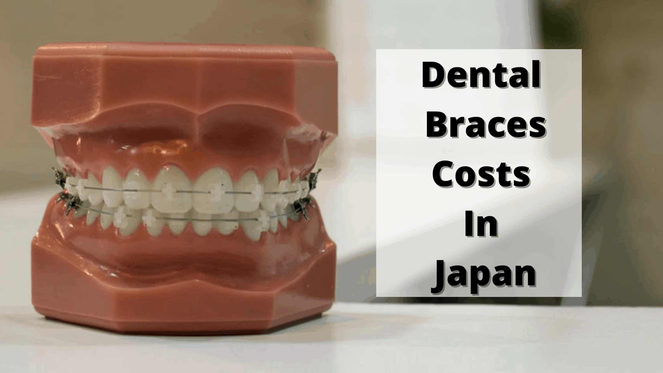 Dental Braces Costs In Japan 2026 - My Guide as an Expat – Japan Truly